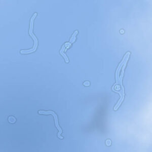 Miodesopsias - Instituto Oftalmológico Recoletas