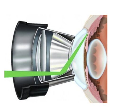 Láser Pascal - Instituto Oftalmológico Recoletas