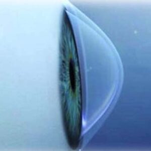 Crosslinking corneal - Instituto Oftalmológico Recoletas