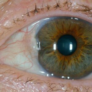 Pterigión - Instituto Oftalmológico Recoletas