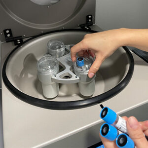 PRGF-Endoret en el tratamiento quirúrgico del agujero de mácula ...